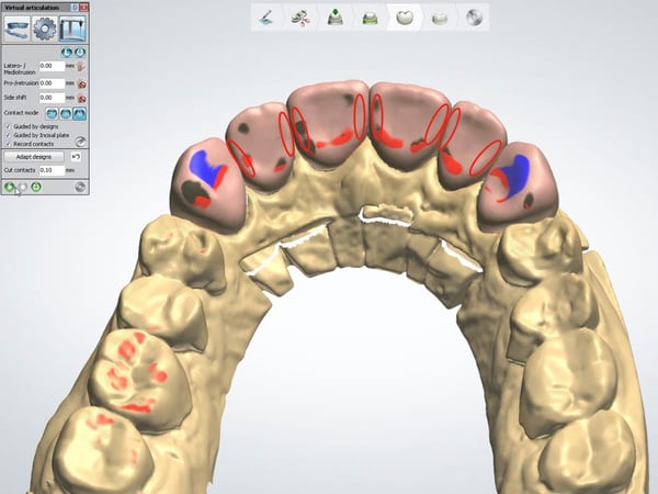 Proper Adjustment of an Anterior Smile Case with the 3Shape Virtual Articulator - Part 2